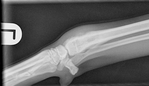 Osteosarcoma In Dogs Distal Radius